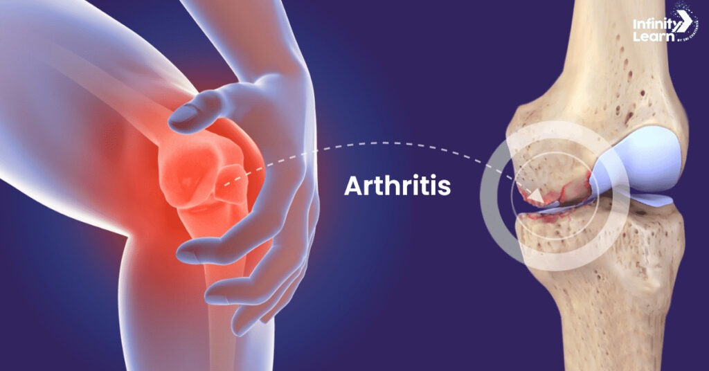 Arthritis: Types, Symptoms & Effective Treatments for Joint Pain ...